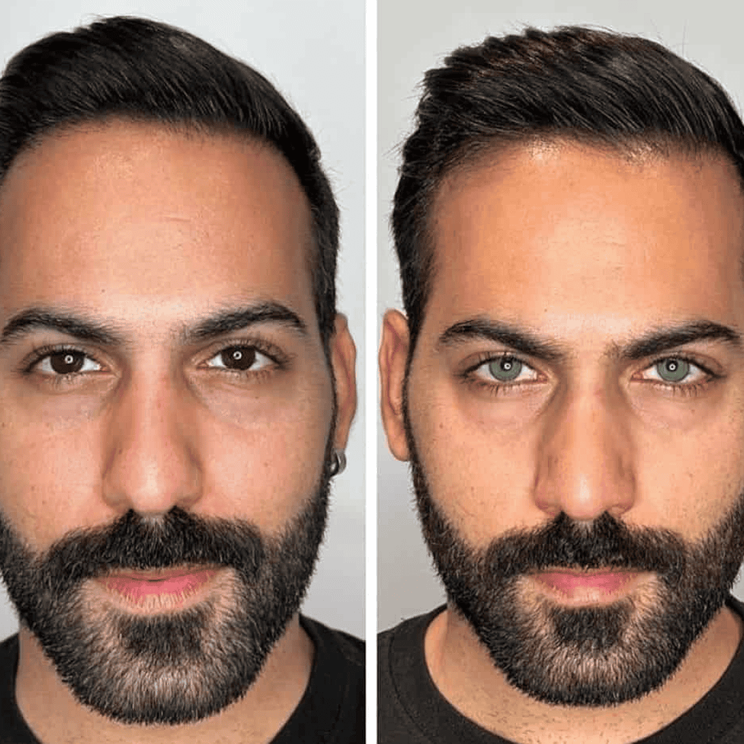 Kerato Eye Color Change Surgery | What Nature Doesn't Do, Color Does