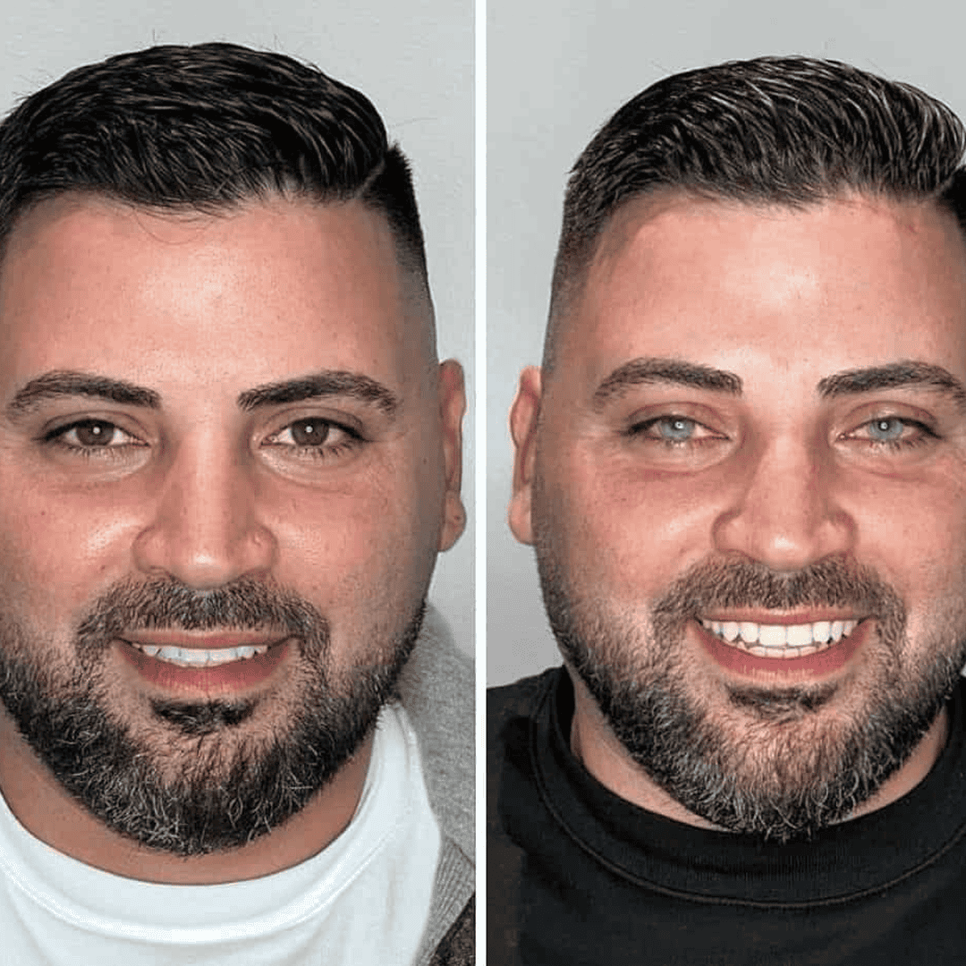 Kerato Eye Color Change Surgery | What Nature Doesn't Do, Color Does