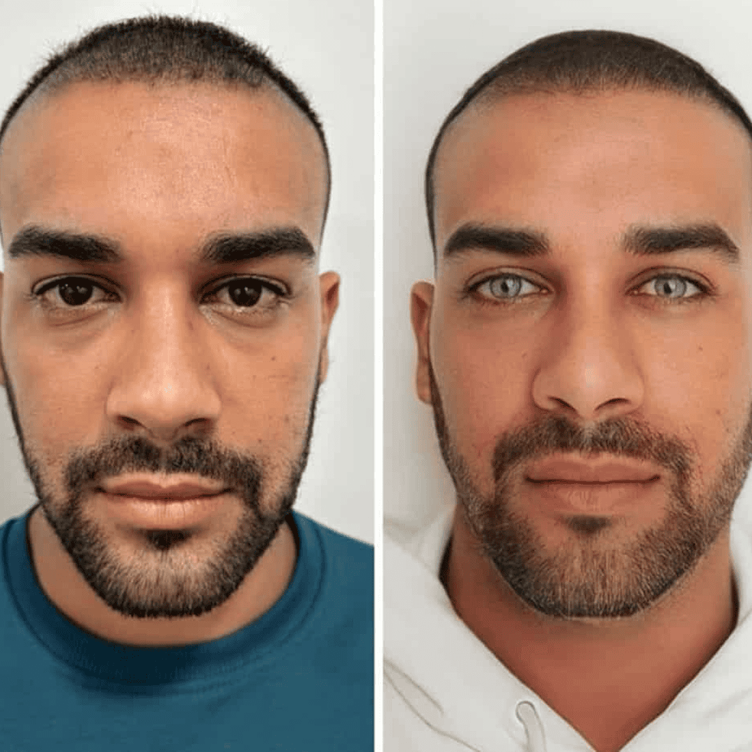 Kerato Eye Color Change Surgery | What Nature Doesn't Do, Color Does